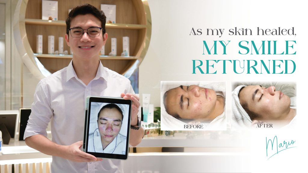 Mario | Caring Skin Success Story | As My Skin Healed, My Smile Returns ...