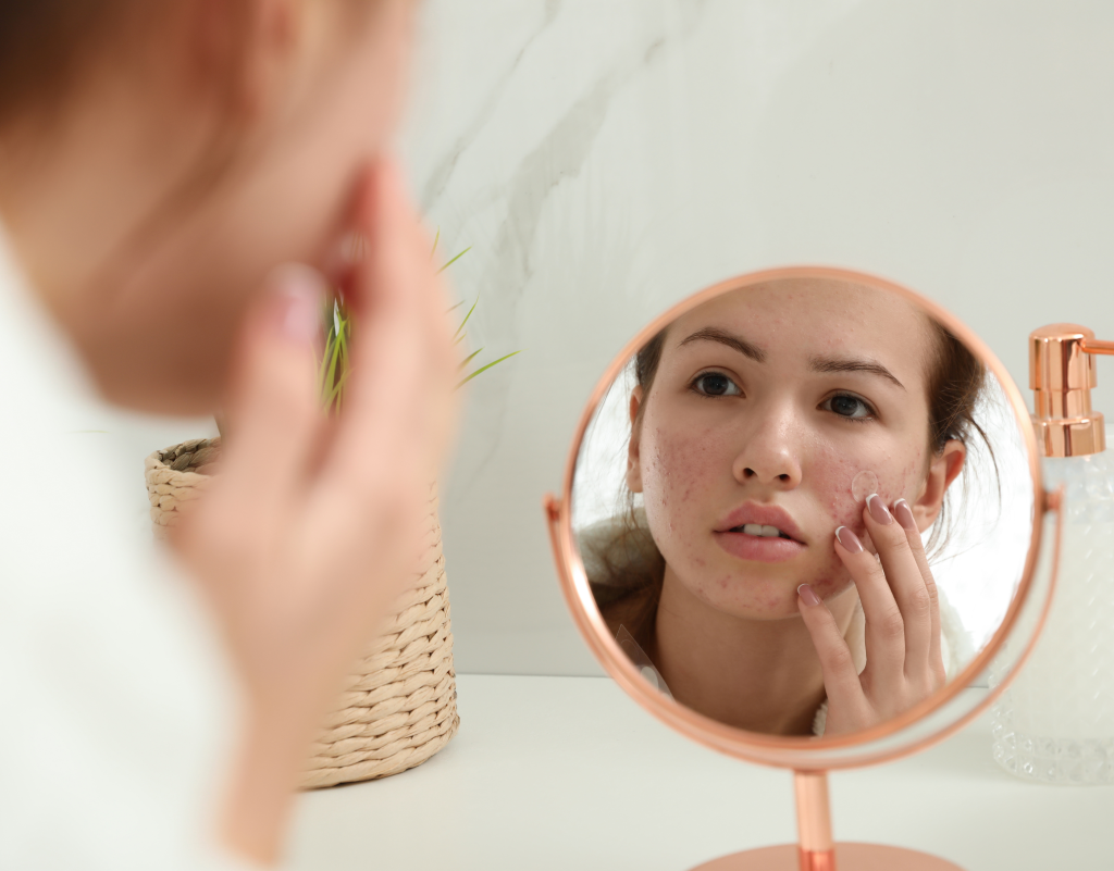 Can Your Diet Be Causing Acne? Here are the 5 Reasons | Caring Skin